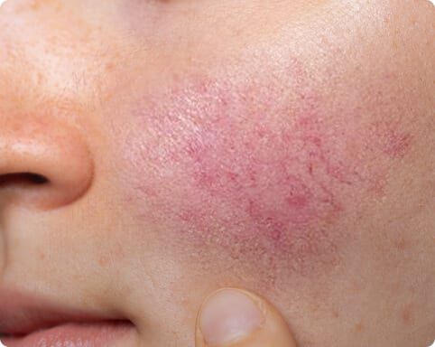 psoriasis on cheeks